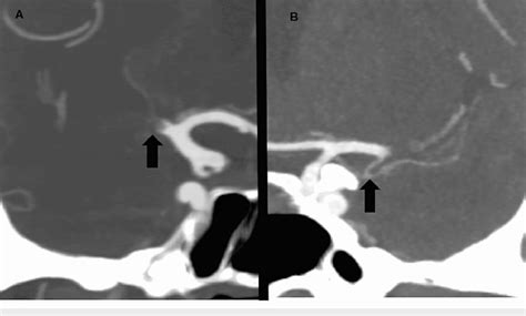 Coronal Ct Angiography Example Of The Presence And Absence Of The
