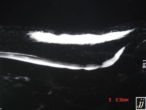 Subcutaneous Cellulitis Radiopaedia