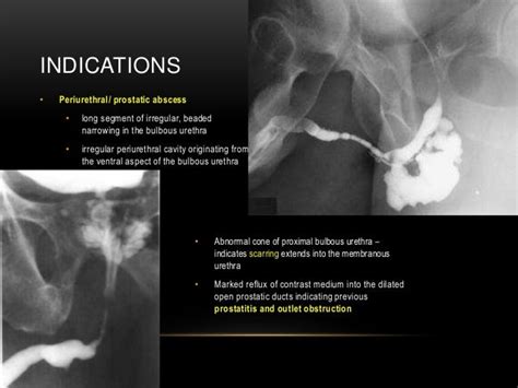 Ascending Urethrogram