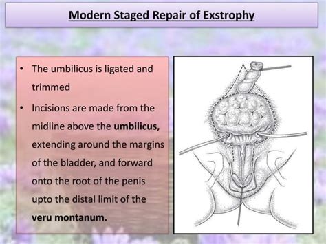 Exstrophy Epispadias Complex Msre And Cpre Ppt