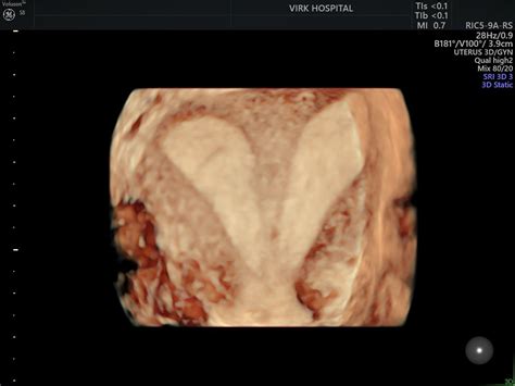 Dr Dikshant Singh On Linkedin Case Of Complete Septate Uterus On 3d