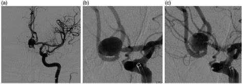 Transradial Access For Embolization Of Cerebral Aneurysms With The Woven Endobridge Device Case