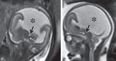 Normal And Abnormal Development Of The Posterior Fossa Structures Clinical Tree