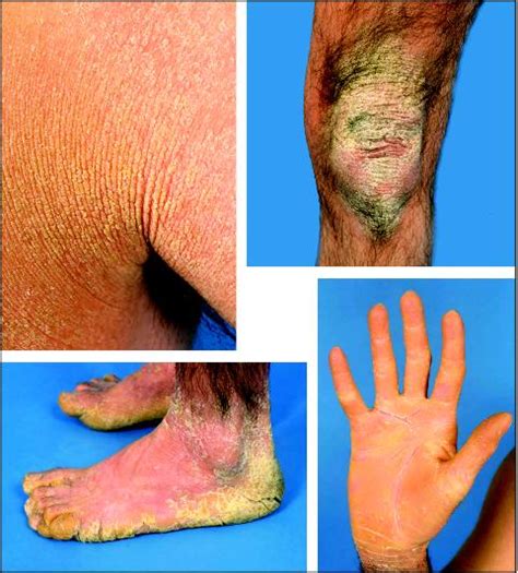Epidermolytic Ichthyosis Symptoms Successful Topical Adapalene Treatment For The Facial