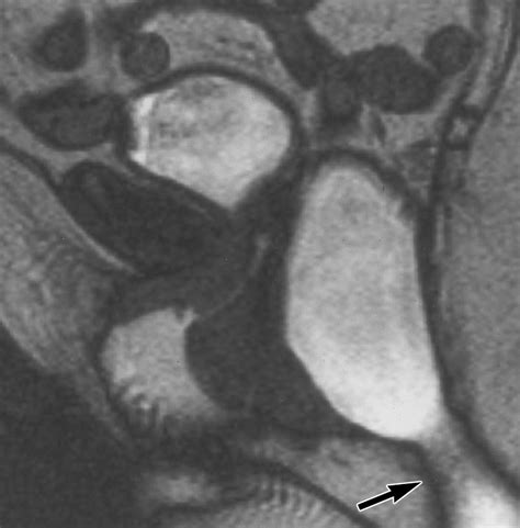 Female Pelvic Organ Prolapse A Comparison Of Triphasic Dynamic Mr