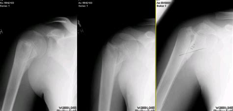 Pediatric Proximal Humerus Fracture