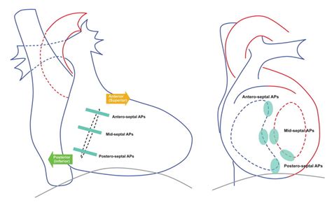 ECG Analysis Of Pre Excitation WPW Without Algorithms EP Made Easy