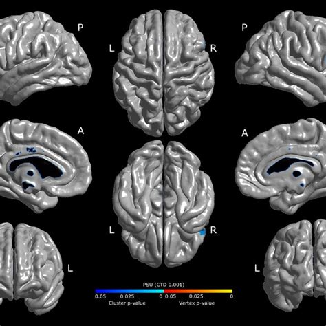 Significant Clusters Of The Correlation Between Cortical Thickness And Download Scientific