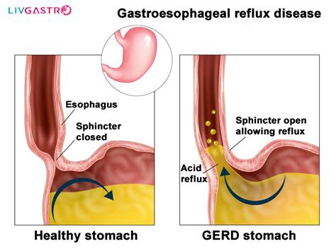 Gastro Esophageal Reflux Disease Causes Symptoms