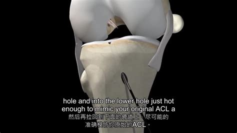 【acl科普系列】前交叉韧带重建手术过程3d演示（双语字幕） 哔哩哔哩 ゜ ゜ つロ 干杯~ Bilibili