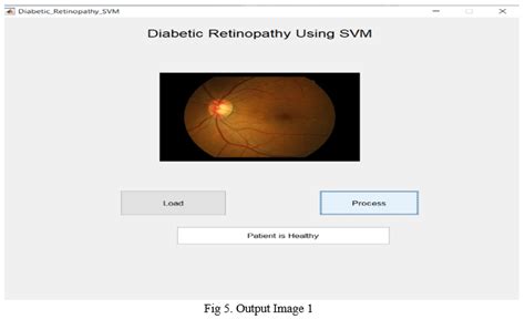 Diabetic Retinopathy Detection Using Svm