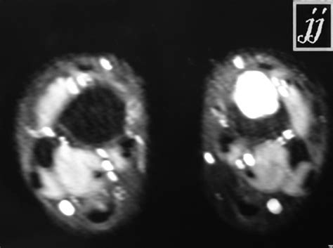 Distal Tibial Cyst Radiopaedia
