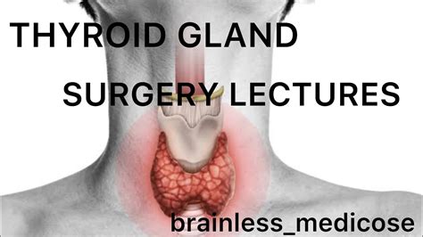 Thyroid Surgery Lecture Part 10 Hypothyroidism Mxoedema Coma Hypothyroid Surgery Myoedema