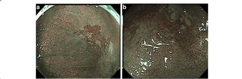 A Nbi Revealed A Demarcated Brownish Dotted Area Before Magnification Download Scientific