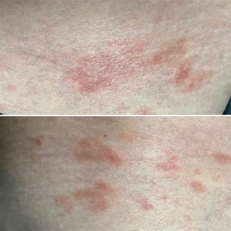 Please Help Non Itchy Spreading Redbrown Patches At Least For 2 3 Months Any Idea What Can