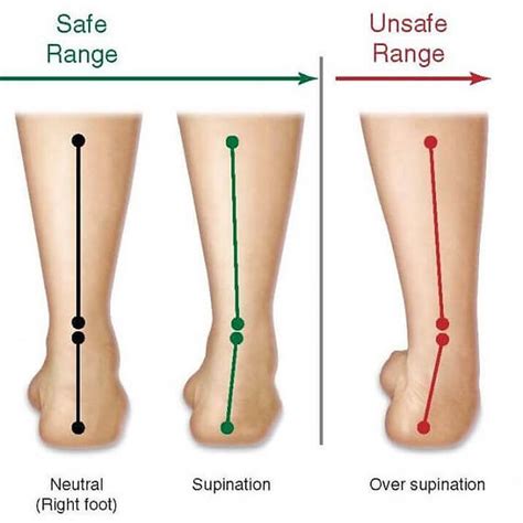 Supination Of Foot Orthotics Arch Support Shoes Insolesinserts For