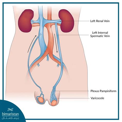 Varicocele Causes Prevention And Treatment Bimaristan