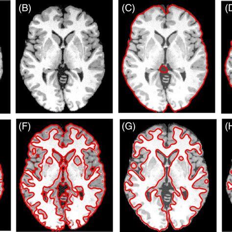 Segmentation Results Of The Mri Brain Tissues Ab Original Brain
