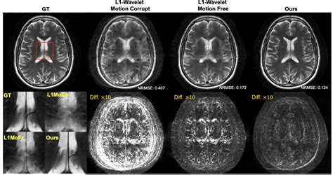 Robust Mri Using New Algorithms For Generative Machine Learning