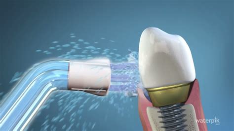 Waterpik Water Flosser Plaque Seeker Tip How To Use Guide For Anz Youtube