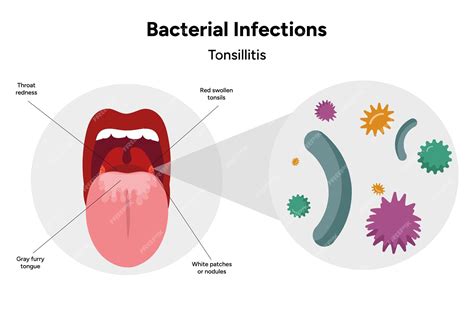 Premium Vector Bacterial Infection Tonsillitis