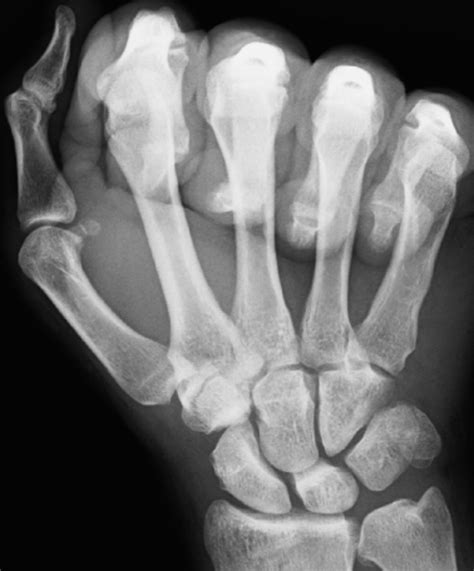 Predynamic Scapholunate Instability With Partial Scapholunate Tear