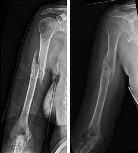 Humerus Fracture Joseph J Schreiber Md