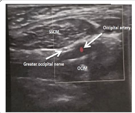 Ultrasound Imaging Of The Dorsal Neck With Color Doppler Shows Greater