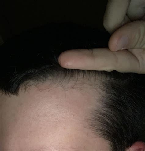 Can Minoxidil Regrow Miniaturized Hairs That Stopped Growing Rminoxidil