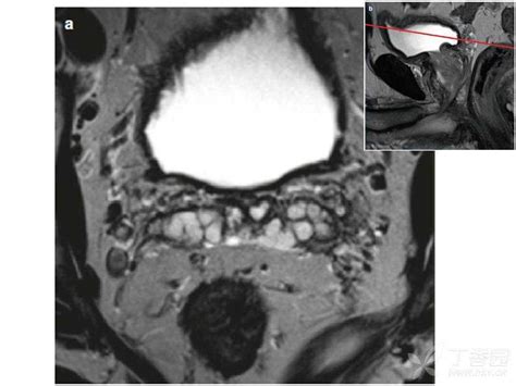前列腺解剖及功能 丁香园论坛