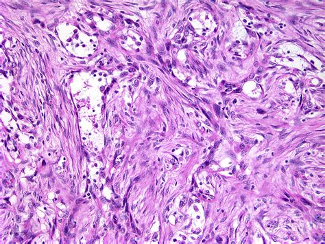 Spindle Cell Cancer At Helen Porter Blog
