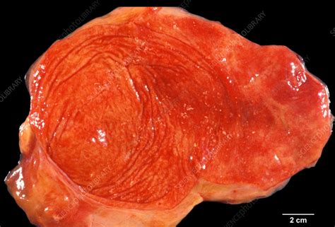 Acute Cholecystitis Stock Image C Science Photo Library