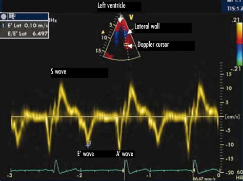 The Doppler Cursor Is Positioned Within The Lateral Left Ventricular Download Scientific