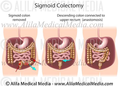 Sigmoid Colon Anatomy Location Function Polyps Divert