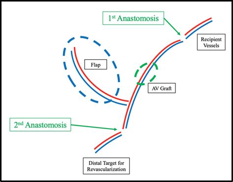 The Use Of Arteriovenous Bundle Interposition Grafts In Microsurgical
