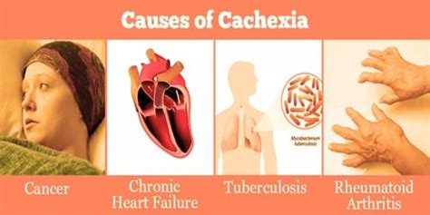 Cachexia Causes Signs And Symptoms Assignment Point