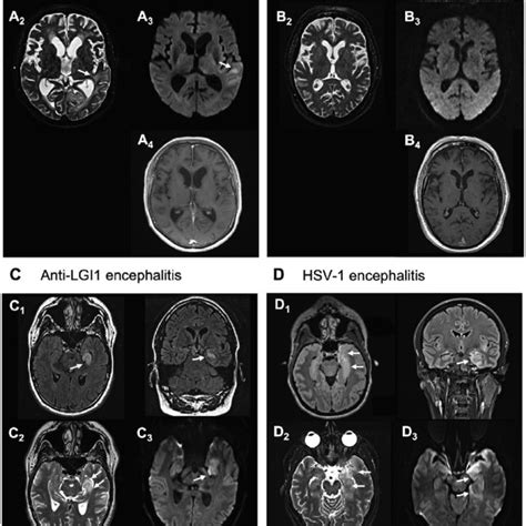 Mri In Patients With Immune Checkpoint Inhibitor Induced Encephalitis Download Scientific