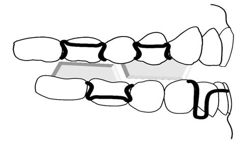 Schematic View Of Reverse Twin Block Appliance Download Scientific