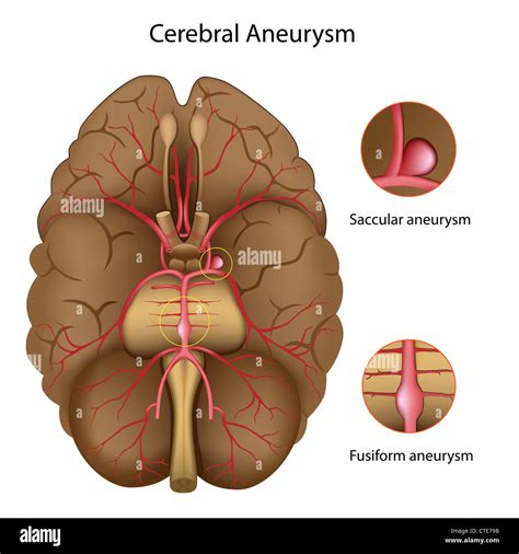 Cerebral Aneurysm Angiogram