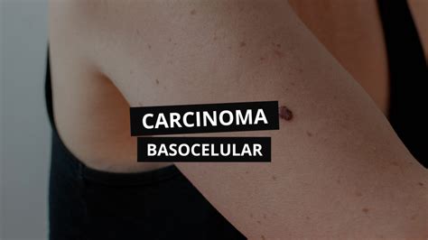 O Que é O Carcinoma Basocelular Cursau Educação Blog