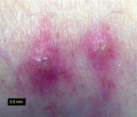 Chigger Bites Vs Bed Bug Bites