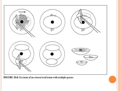 Loop Electrosurgical Excision Procedure