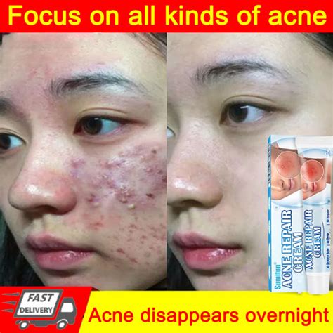 Acne Pimples Remover Cream Original Pimple Marks Remover Serum Pimple Marks Remover Fades Acne