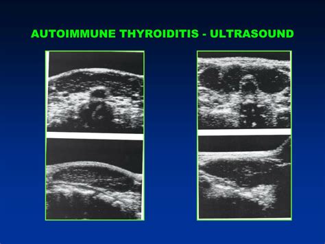 Ppt Thyroiditis Powerpoint Presentation Free Download Id3635117