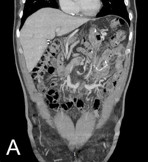 Petersens Internal Hernia After Laparoscopic Roux En Y Gastric Bypass