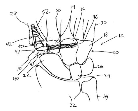 Carpometacarpal Joint Patented Technology Retrieval Search Results Eureka Patsnap
