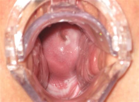 Angel Anna Set 226 Speculum 226 62 Porn Pic Eporner