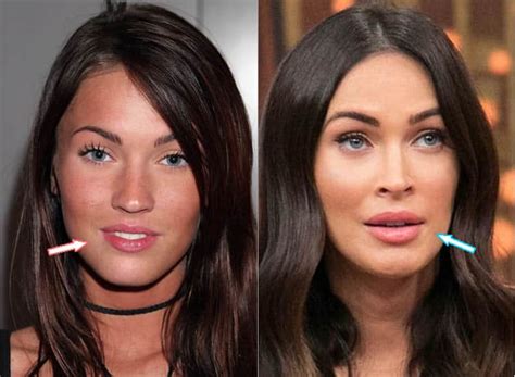 Has Megan Fox Had Cosmetic Surgery