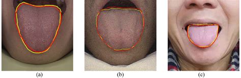 The Segmentation Result Of The Tongue Image Where The Golden Contours Download Scientific