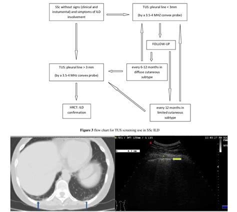 A Reticular Nodular Hrct Pattern Limited To Basal Area And Download Scientific Diagram